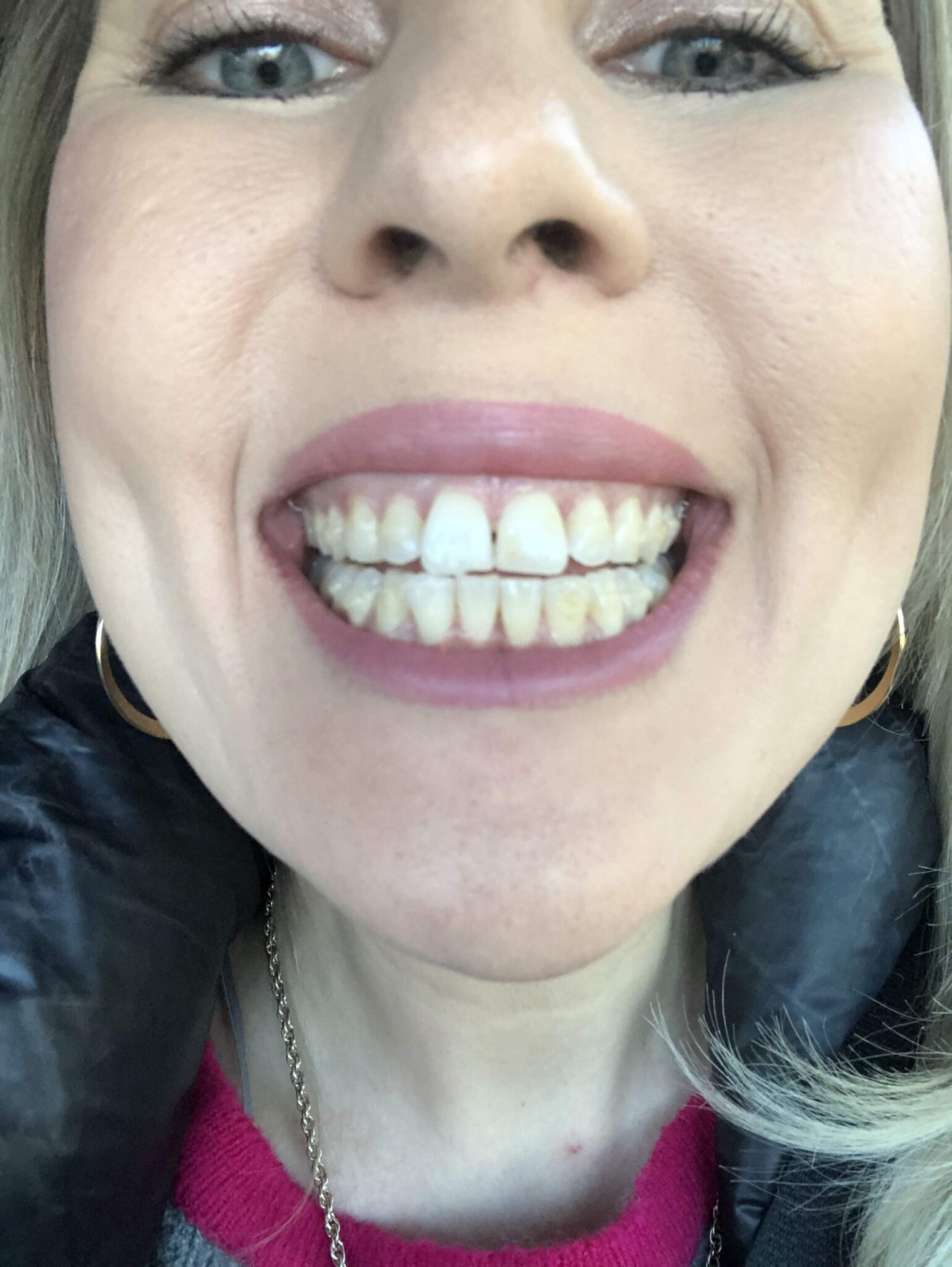 Invisalign Review